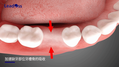 Accelerate the absorption of alveolar bone in missing teeth