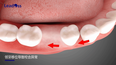 Displacement of adjacent teeth leads to occlusion disorder