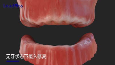 Multiple Teeth Restoration for Edentulous